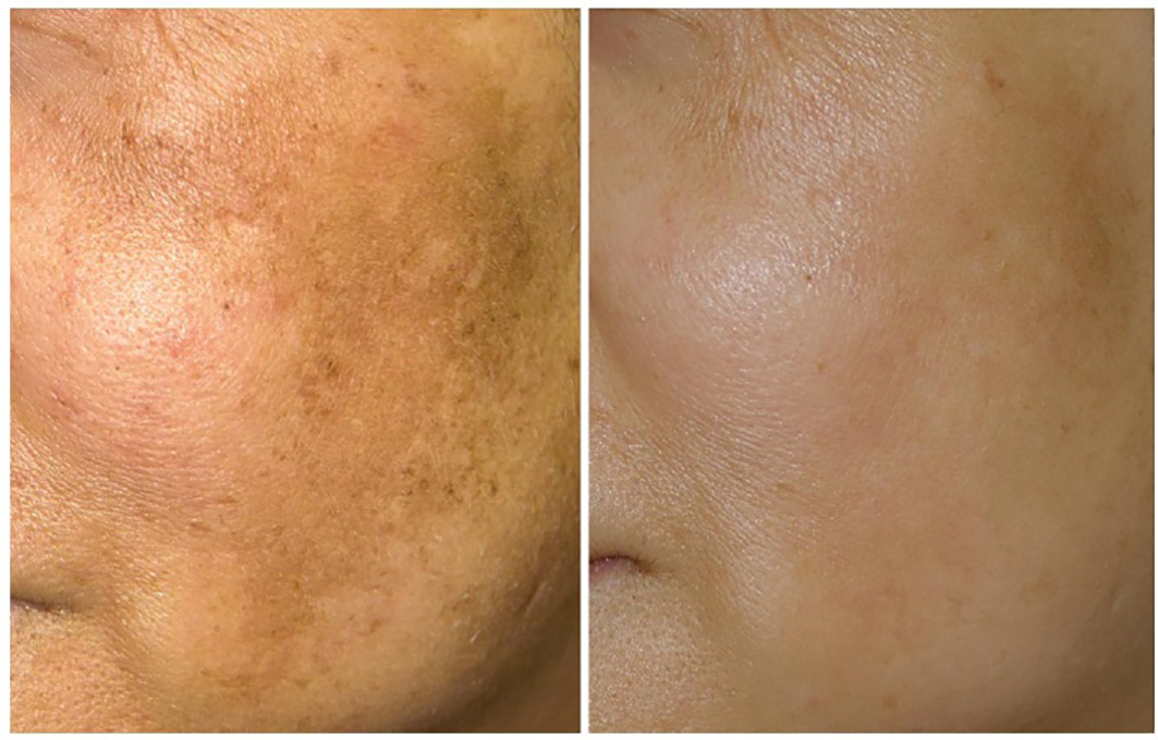 Huidverzorging bij melasma | Huid & Laser Utrecht