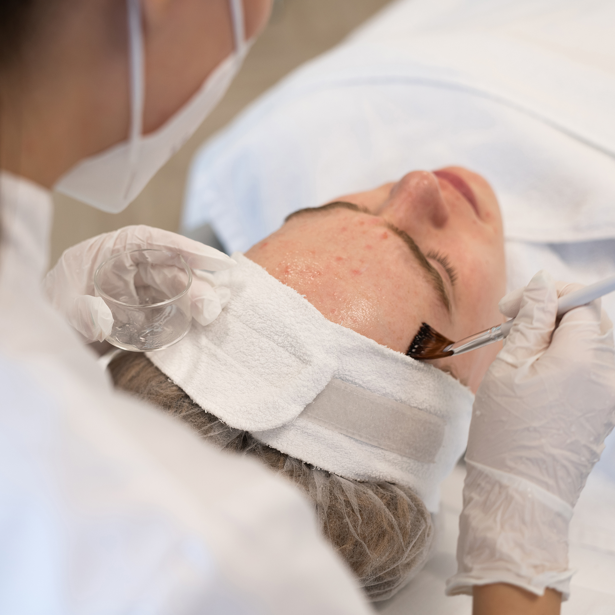 Acne behandeling in Utrecht | Huidkliniek | Huid & Laser Utrecht