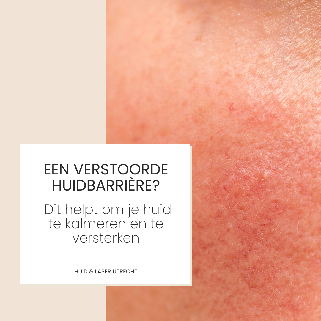 Een verstoorde huidbarrière? Dit helpt om je huid te kalmeren en ...