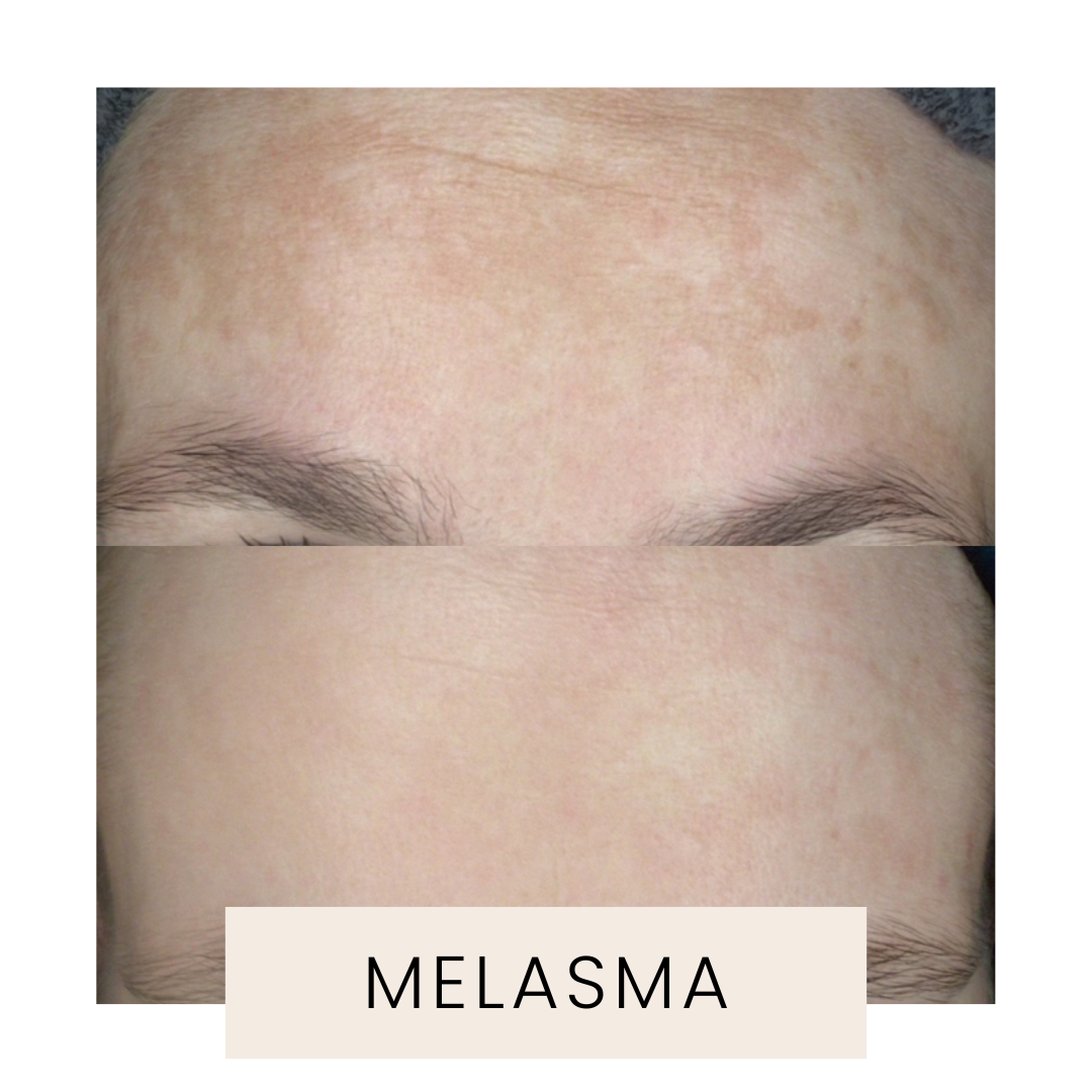 Dit is de periode om je melasma te behandelen | Huid & Laser Utrecht